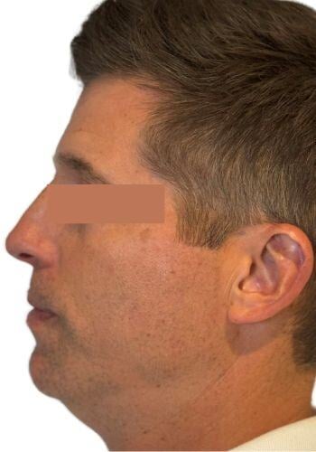 EVERESSE: Non-Invasive Monopolar RF Device