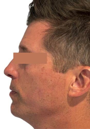 EVERESSE: Non-Invasive Monopolar RF Device