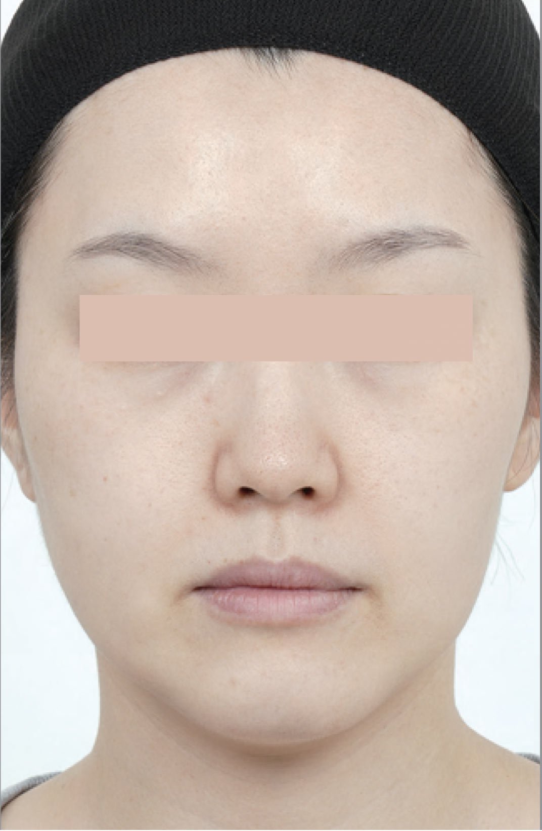 EVERESSE: Non-Invasive Monopolar RF Device