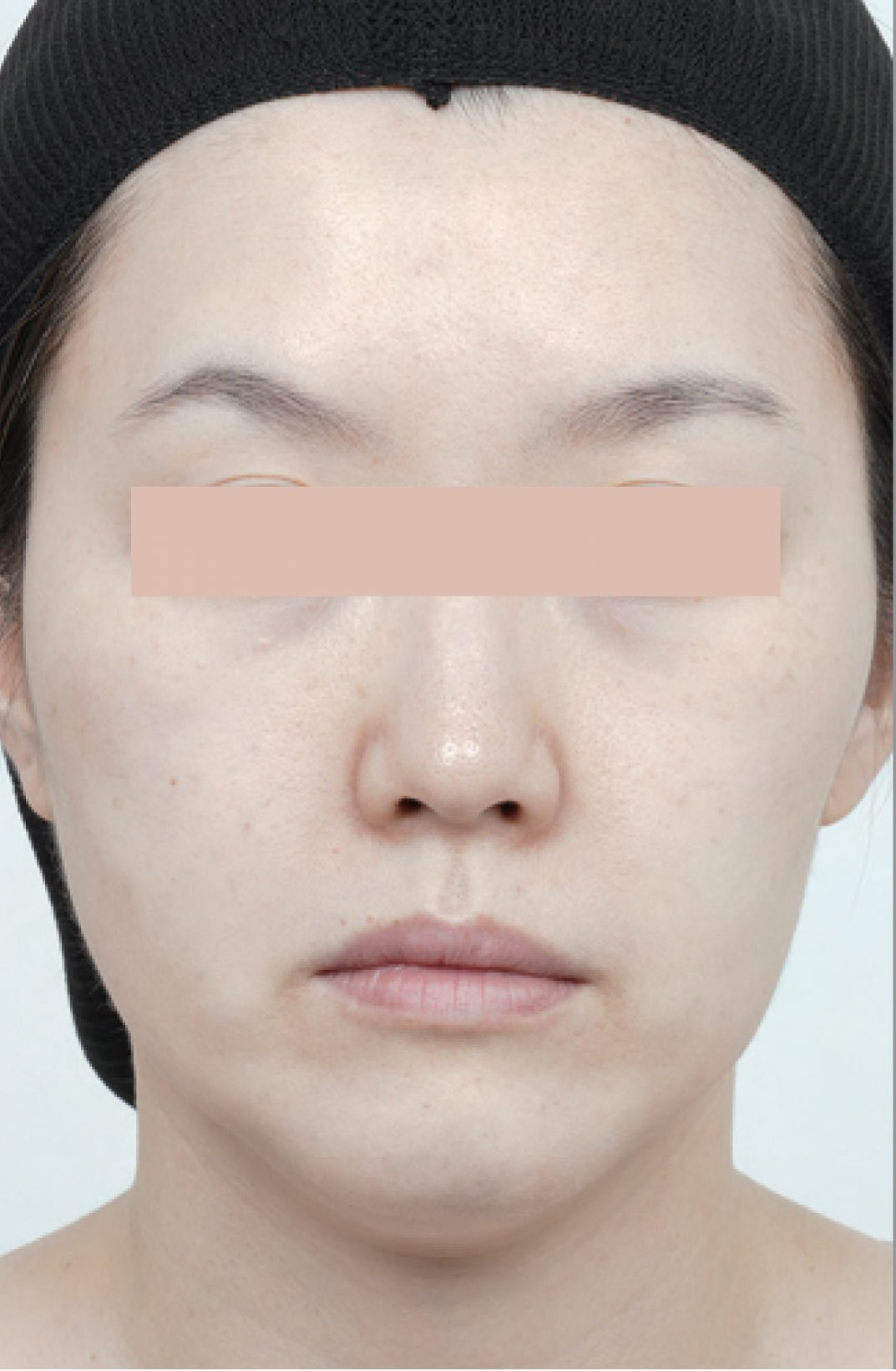 EVERESSE: Non-Invasive Monopolar RF Device