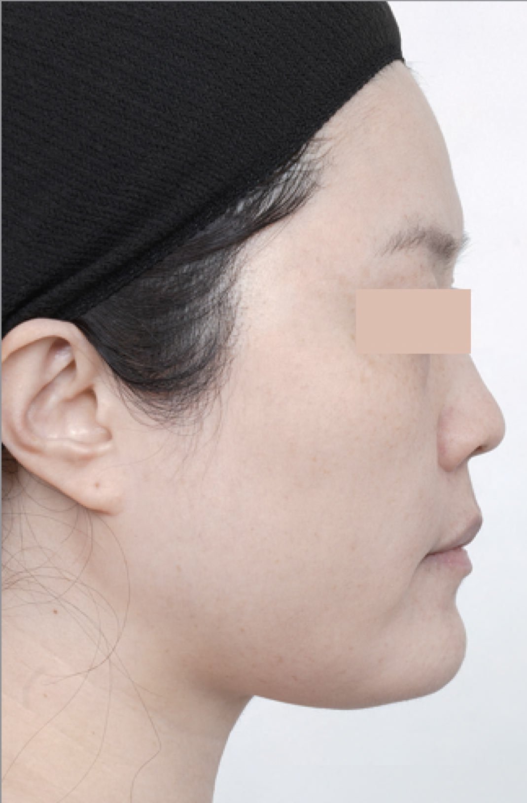 EVERESSE: Non-Invasive Monopolar RF Device