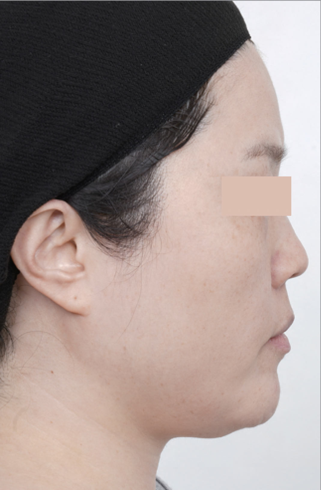 EVERESSE: Non-Invasive Monopolar RF Device