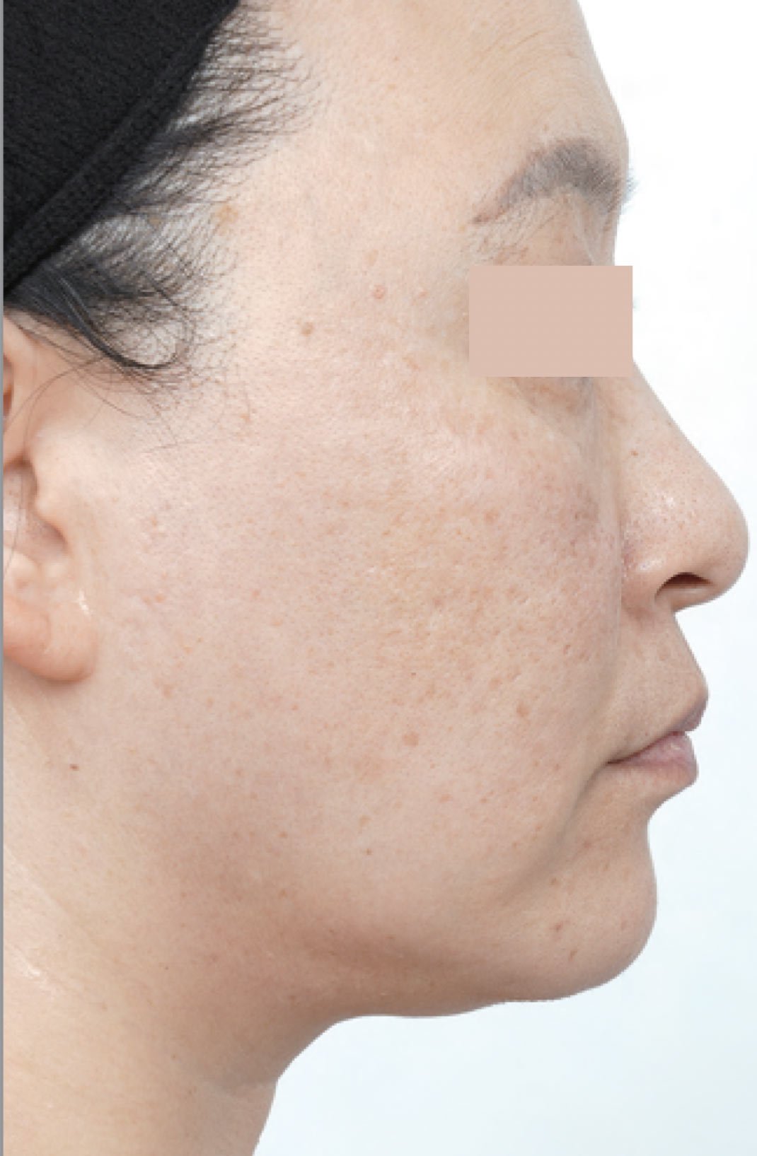 EVERESSE: Non-Invasive Monopolar RF Device