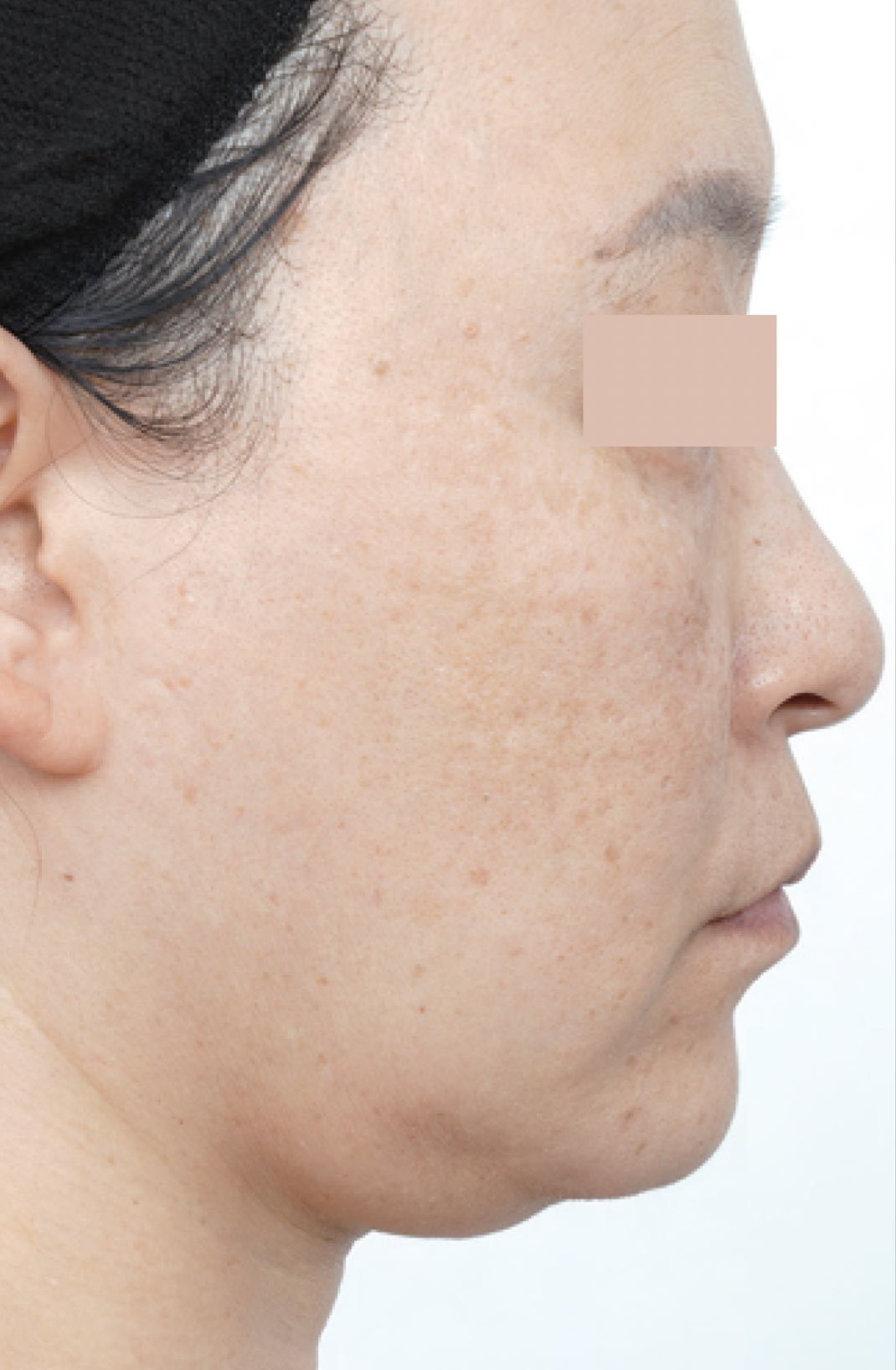 EVERESSE: Non-Invasive Monopolar RF Device