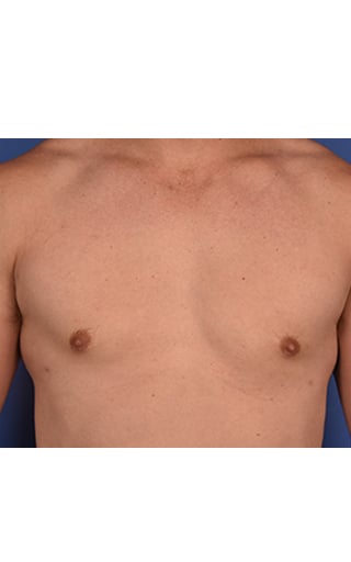 LipoAI - The Next Generation of Laser-Assisted Lipolysis