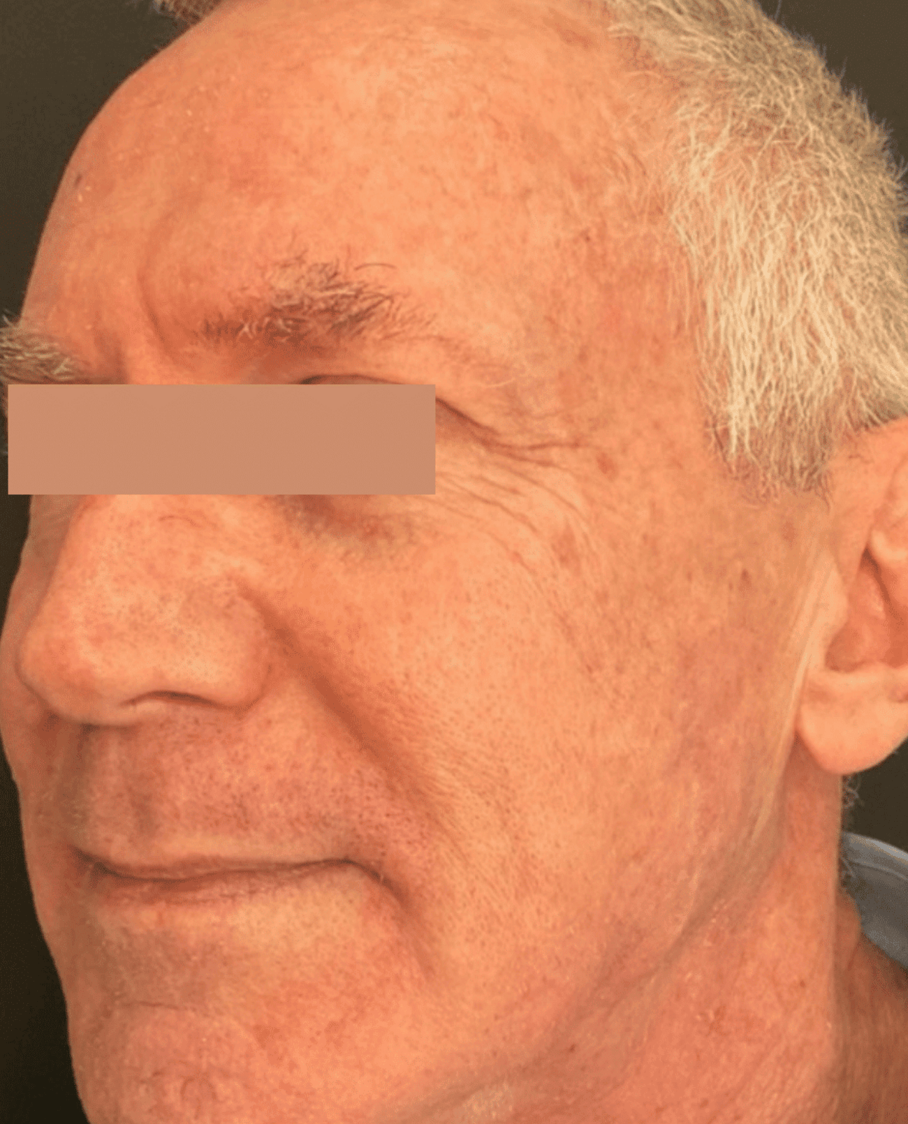 MoveoGlo Laser Treatment for Advanced Skin Revitalization