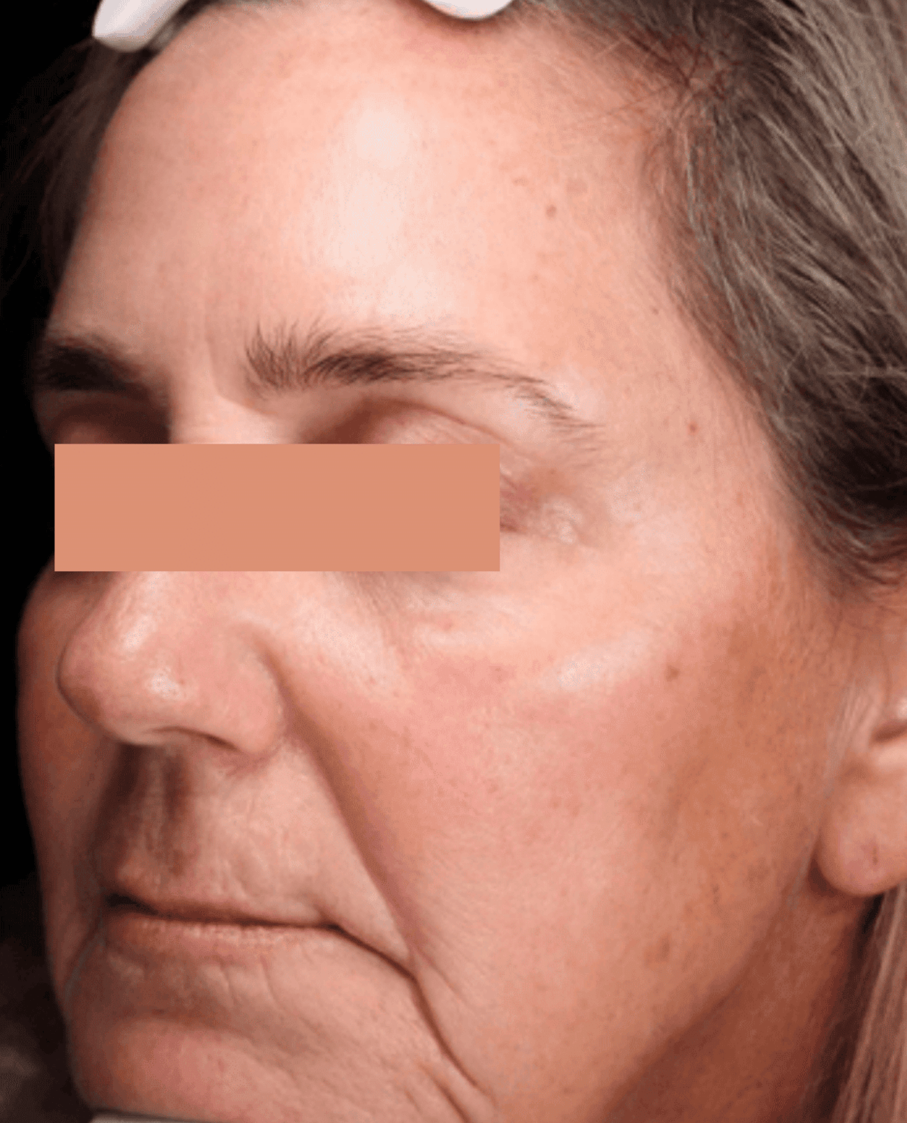 MoveoGlo Laser Treatment for Advanced Skin Revitalization