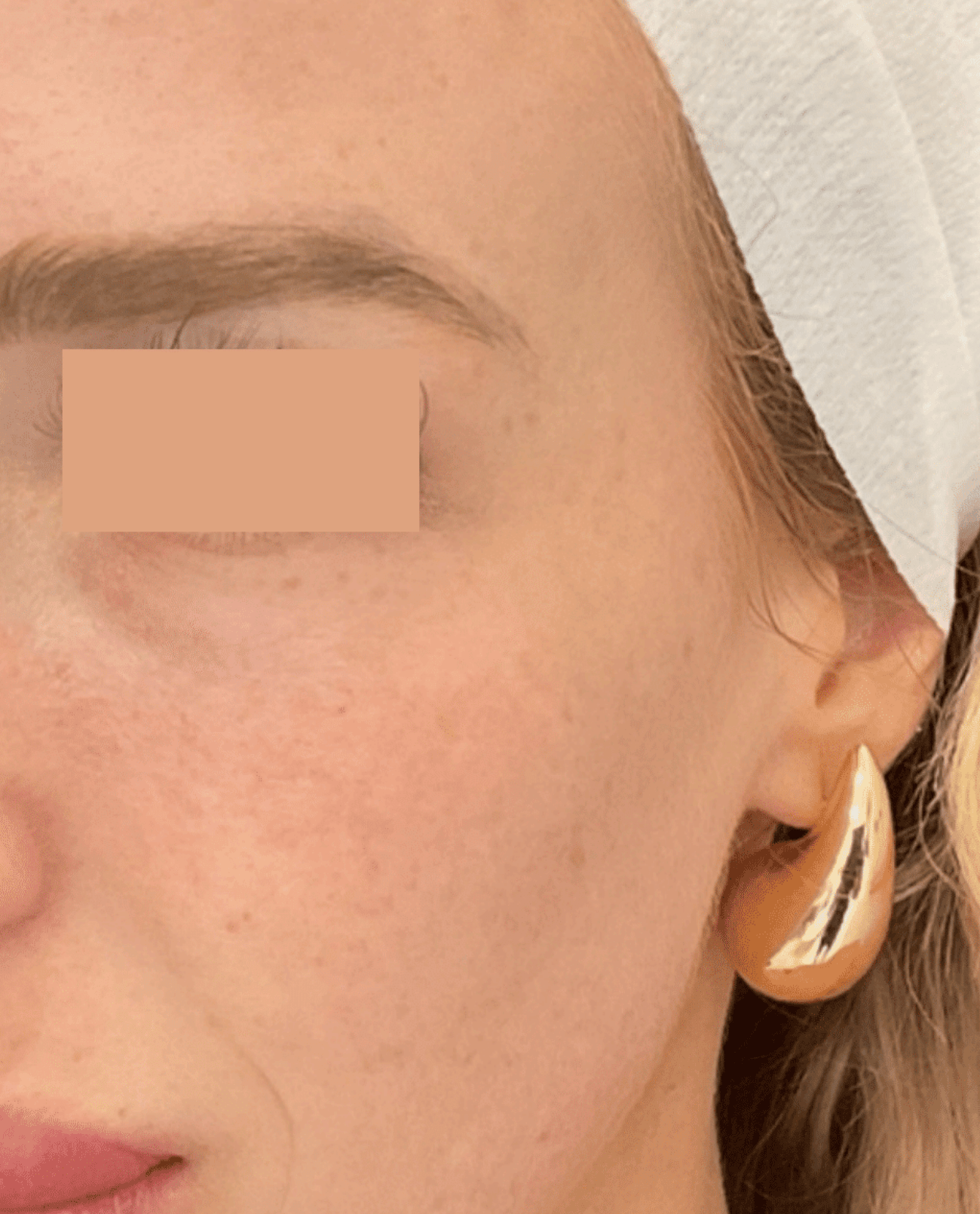 MoveoGlo Laser Treatment for Advanced Skin Revitalization
