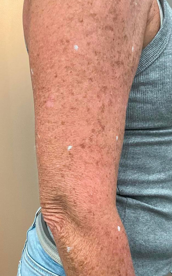 Laser Treatments for Pigmentation Concerns and Vascular Lesions