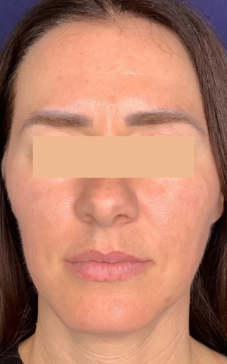 Suprema - Cartessa Aesthetics